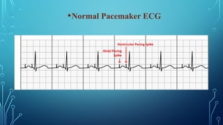 1.pptx power point presentation on pacemaker | PPTX