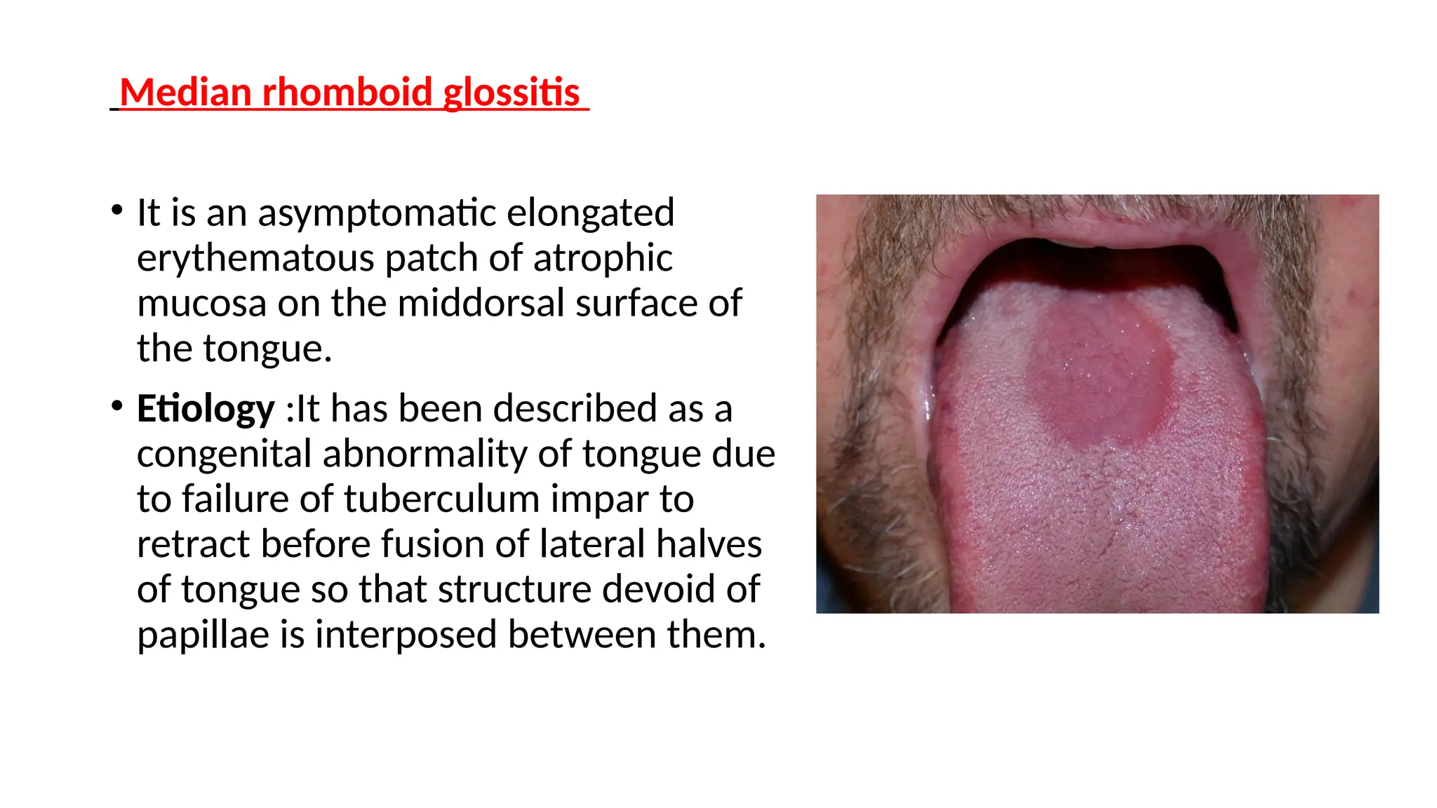 Development of tongue and its significance in prosthodontics | PPTX
