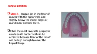 Development of tongue and its significance in prosthodontics | PPTX