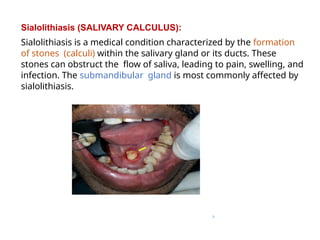 1.3)Salivary gland disorder by khyber medical university l | PPTX