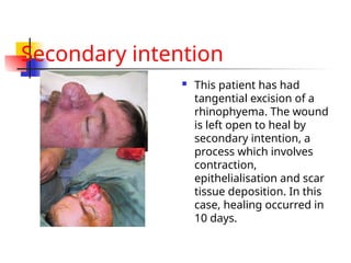 1. Wound management Wound management.ppt