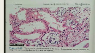 1.6. calcification-ppt. in cell injury. its a process of calcium builds ...