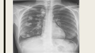 1.6. calcification-ppt. in cell injury. its a process of calcium builds ...