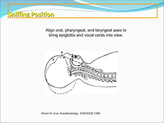 1.AIRWAY ASSESSMENT LOOK, LISTEN, FEEL: Mallampati, LEMON, neck ...