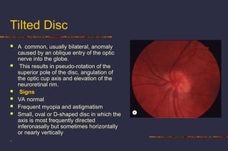 1. ON Anomalies.ppt for ophthalmology students | PPT