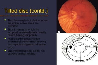 1. ON Anomalies.ppt for ophthalmology students | PPT