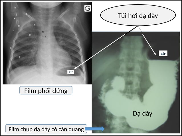 1. Dạ dày.pptx dạ dày dạ dày ddddddddddd | PPTX