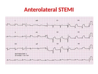 Acute Coronary Syndrome lecture in cardiology | PPTX