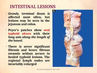 Typhoid Fever- Dr. Pallavi Chougule, M. D (RNVV) | PPTX