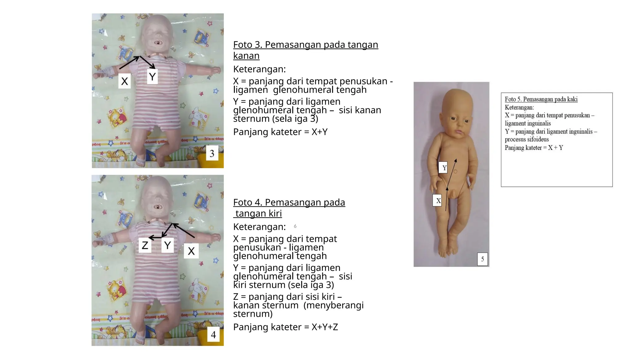 Tatalakasana Pemasangan Percutaneus Insertion Central Catheter (PICC ...