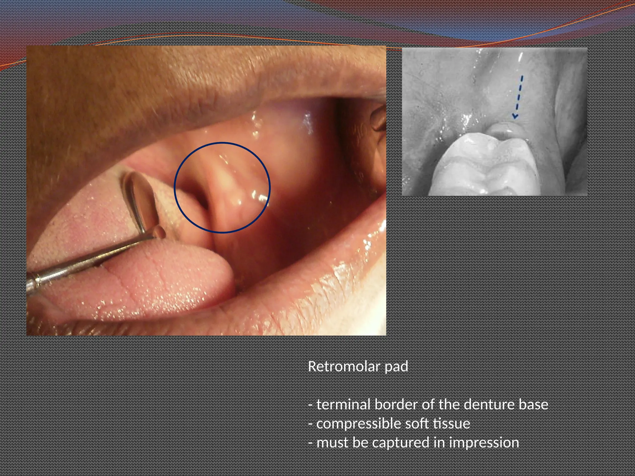 Complete denture Introduction .the way to get start | PPTX