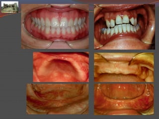 Complete denture Introduction .the way to get start | PPTX