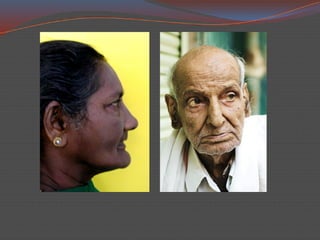 Complete denture Introduction .the way to get start | PPT