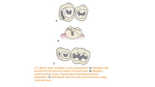 1. CLASS 1 CAVITY PREP.pptx conservative dentistry | PPT