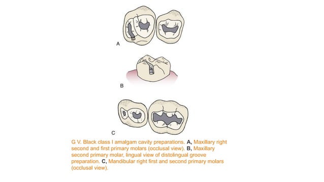 1. CLASS 1 CAVITY PREP.pptx conservative dentistry | PPT