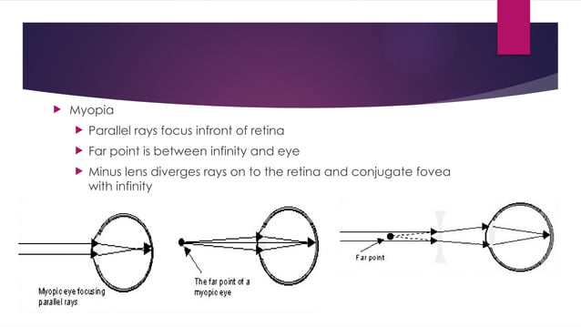 1..far point concept myopia , hypermetropia, emmetropia | PPTX