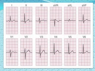 1. ECG Interpretation (basics of Electrical activity ogmf the heart).pdf