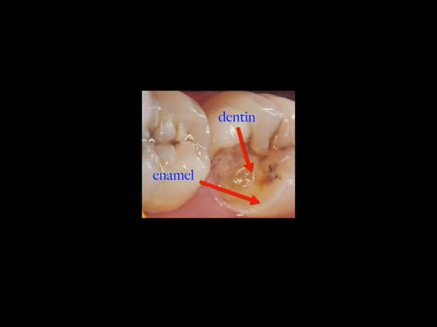 1. Dentin structure of toothtypes of dentin inter | PPT