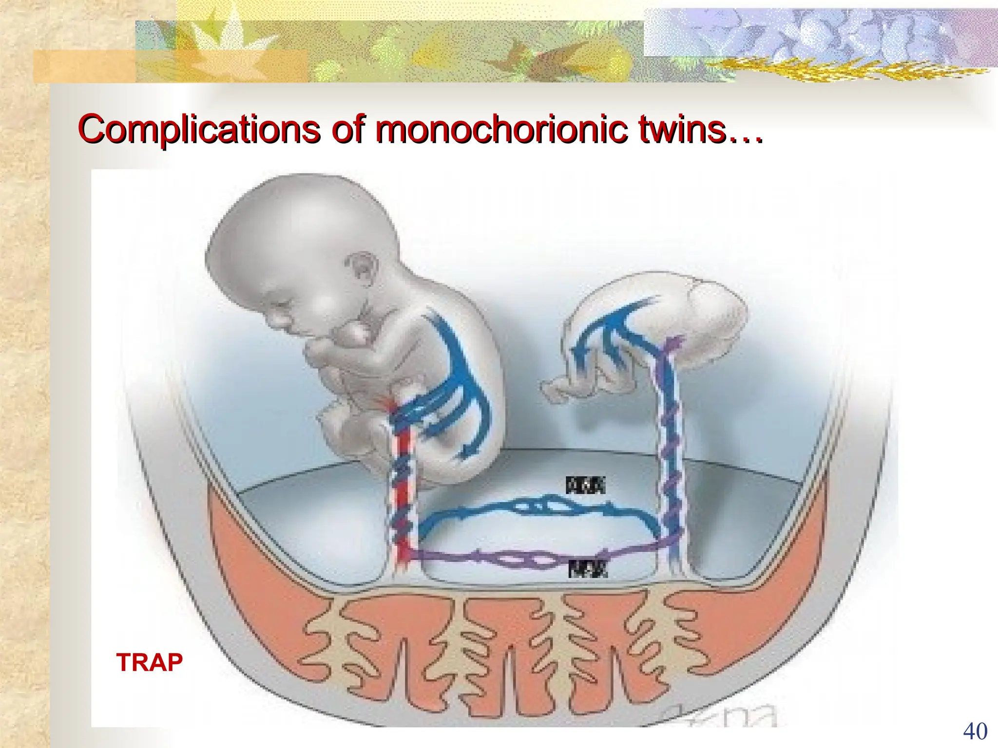 1. Multiple pregnancy & its complication.ppt