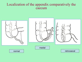 it is an inflammation of the vermiform appendix | PPT