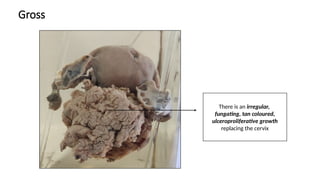 1. Ayre's spatula, carcinoma cervix.pptx