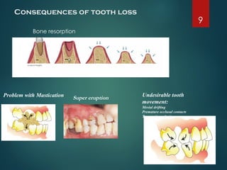 Causes and consequences of tooth loss (1).ppt