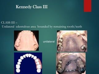 Classification of edentulous arches.ppt