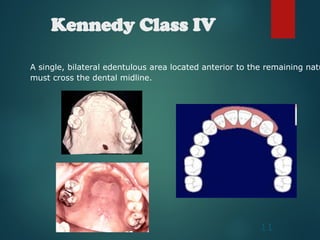 Classification of edentulous arches.ppt