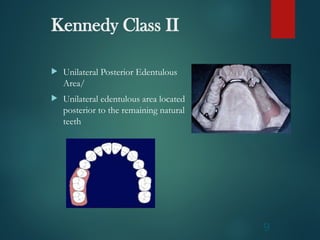 Classification of edentulous arches.ppt
