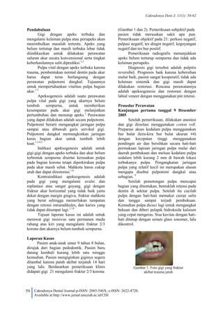 1. PERAWATAN APEKSOGENESIS GIGI INSISIVUS PERMANEN DENGAN AKAR TERBUKA.pdf
