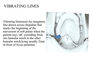 1. Maxillary-Landmarks PROSTHODONTICS .ppt