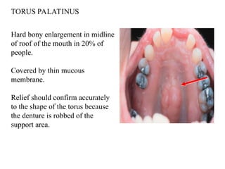 1. Maxillary-Landmarks PROSTHODONTICS .ppt