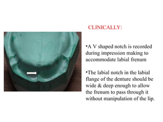 1. Maxillary-Landmarks PROSTHODONTICS .ppt