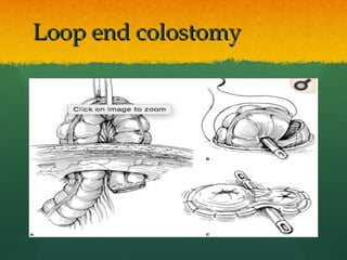1. indikasi, teknik pembuatan stoma, reanastomosisppt.ppt