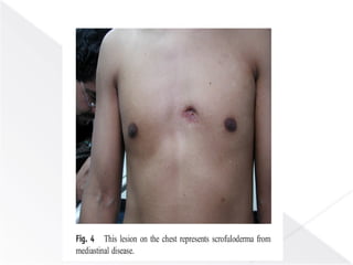 Cutaneous tuberculosis Dermatology | PPTX