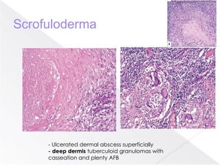 Cutaneous tuberculosis Dermatology | PPTX