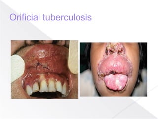 Cutaneous tuberculosis Dermatology | PPTX