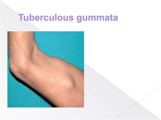 Cutaneous tuberculosis Dermatology | PPTX