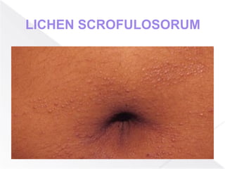 Cutaneous tuberculosis Dermatology | PPTX