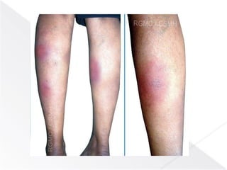 Cutaneous tuberculosis Dermatology | PPTX