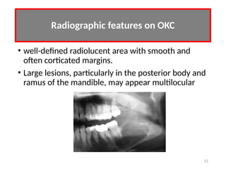 Odontogenic cysts Types histopathology and management | PPTX