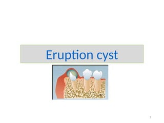 Odontogenic cysts Types histopathology and management | PPTX