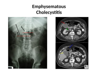 1. Gall bladder and Biliary Disease (3).ppt