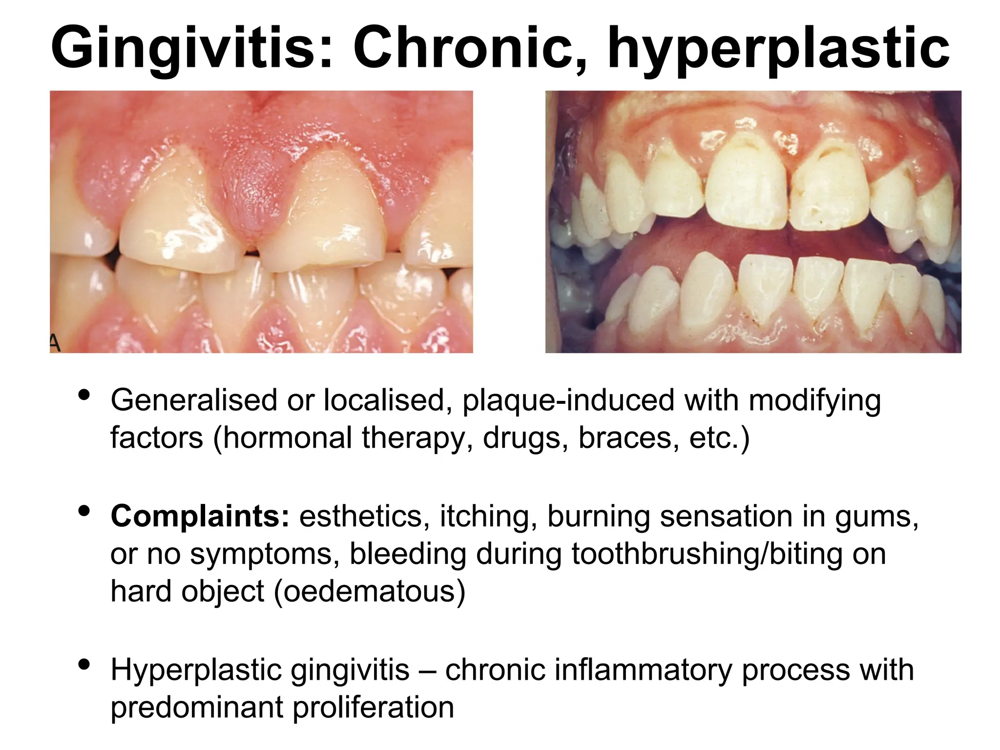 (1).pdf gidivitis dentistry differentiation | PDF