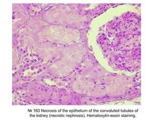 1. Necrosis tissue in pathoanatomy in medical science .ppt