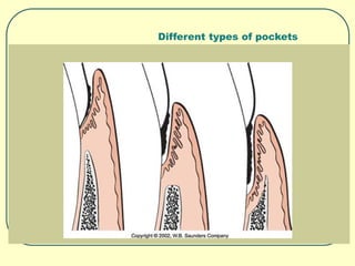 Periodontal-Pocket. what is it and how is it | PPTX