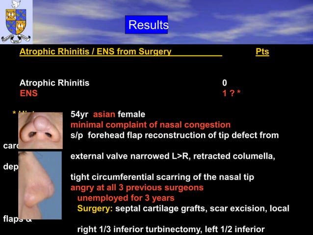 Role for Turbinectomy In the Crowded Nasal Airway, Is Empty Nose ...