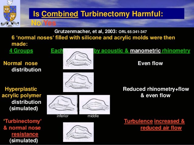 Turbinectomy Side Effects