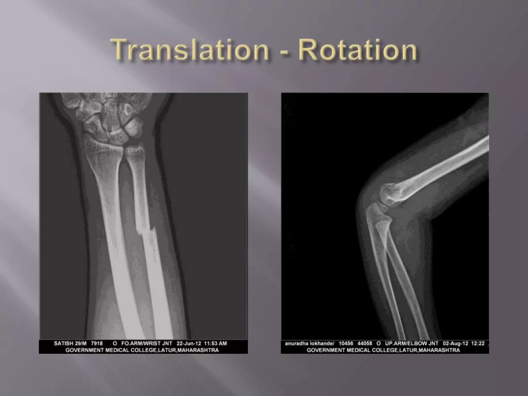 1 2 fracture-classification & management | PPTX