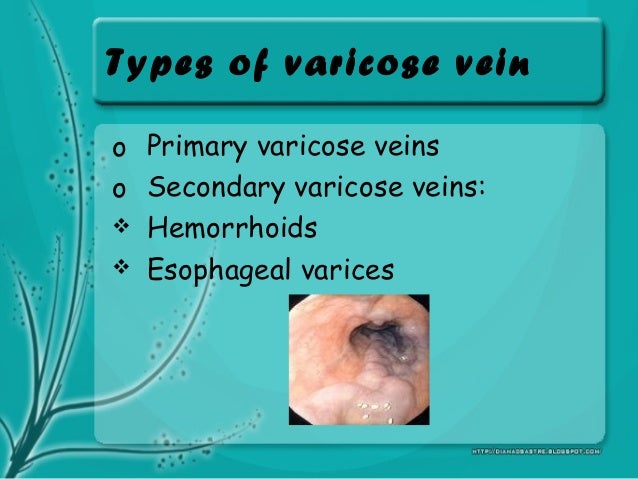 varicose vein